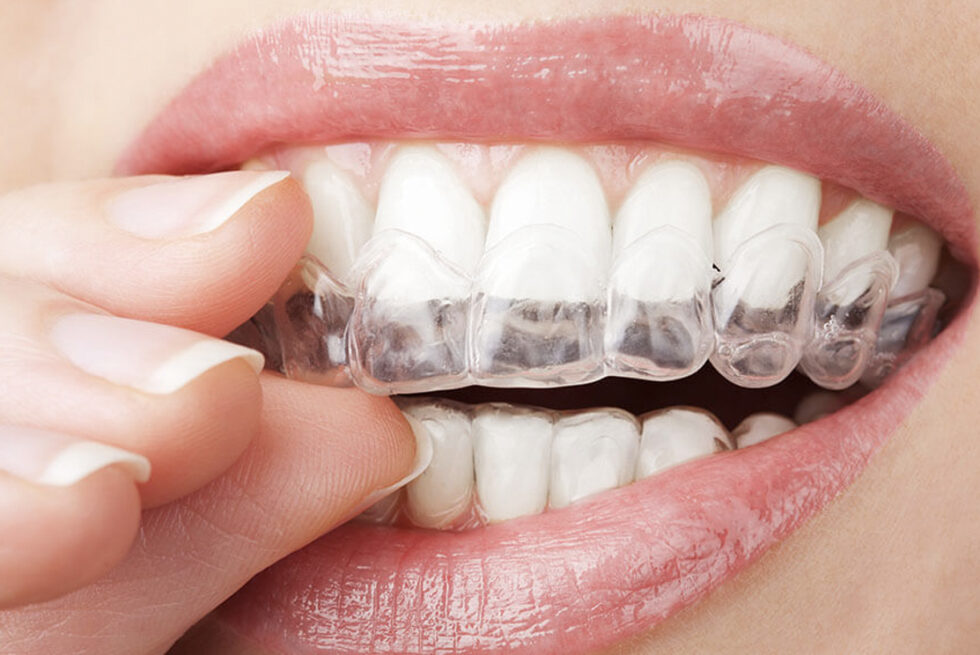 Apretar los dientes al dormir. Qué consecuencias tiene y solución