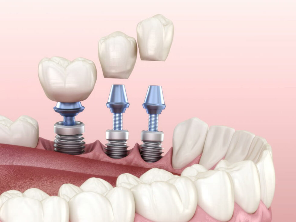 Puente sobre implantes dentales - Clinica Dental Palomero