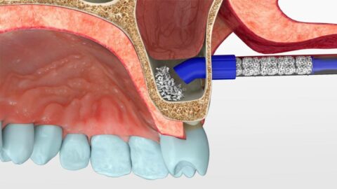 Elevación de seno maxilar para implantes dentales - Clinica Dental Palomero