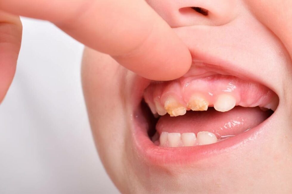 Pulpectomía: la endodoncia de los dientes de leche - Clinica Dental ...