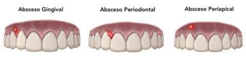 Absceso dental. Tratamiento y causas - Clinica Dental Palomero