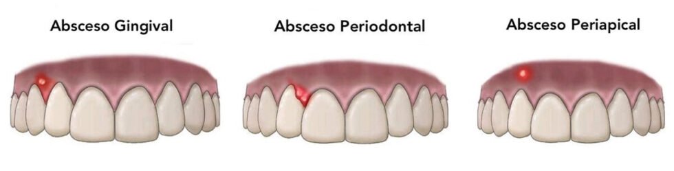 Absceso dental. Tratamiento y causas - Clinica Dental Palomero