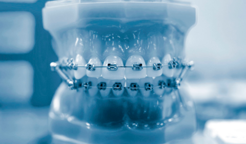 Ortodoncia con brackets en Gijón: Todo lo que necesitas saber - Clinica ...