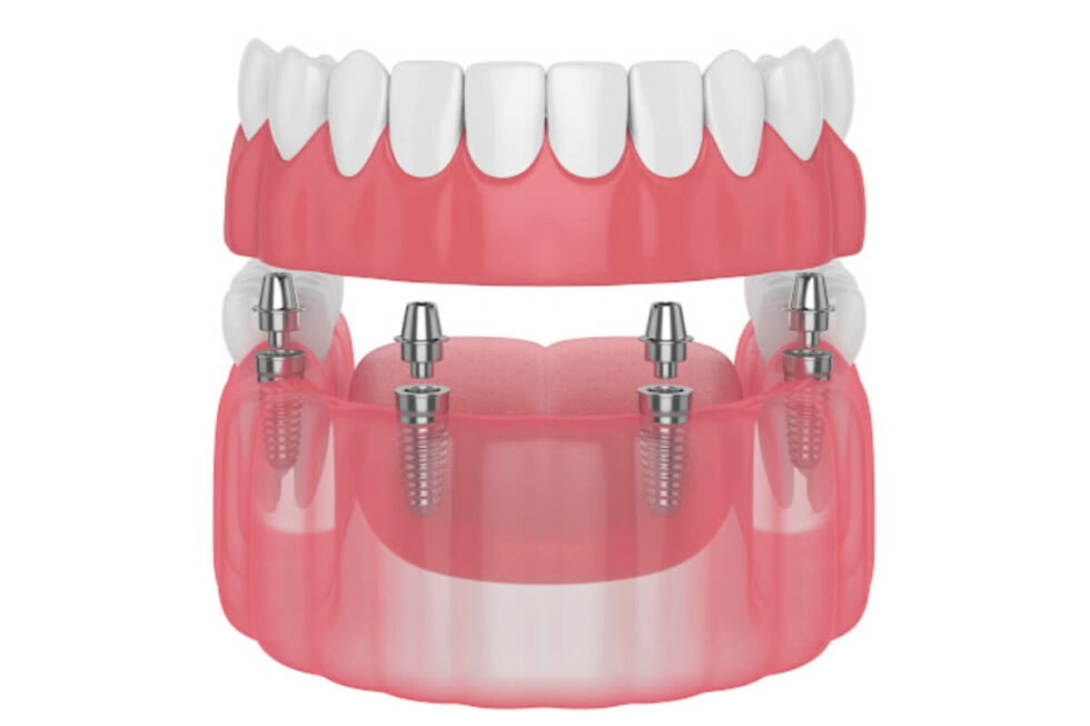 Prótesis sobre implantes dentales: ¿Qué son y qué tipos existen ...